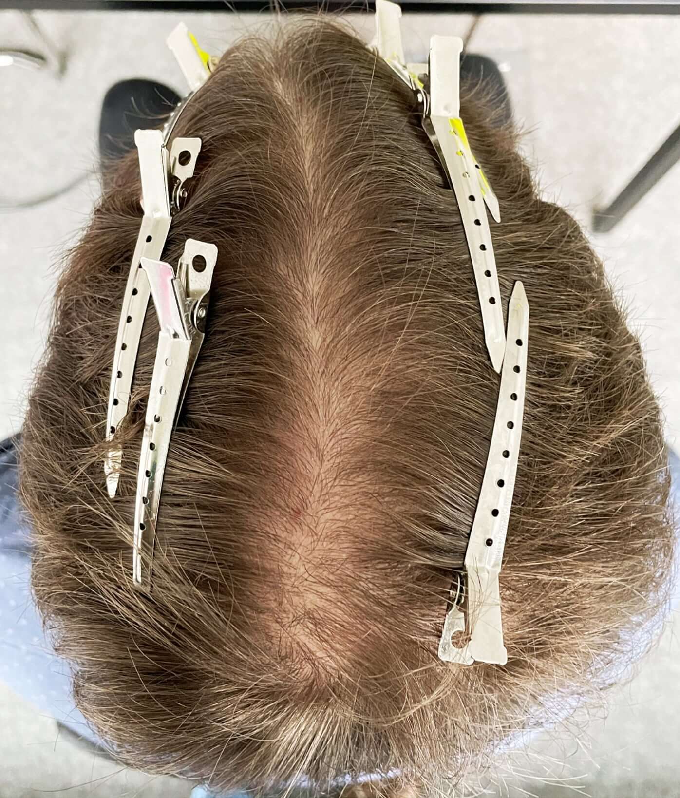 niostem - Wearable technology for hair re-growth