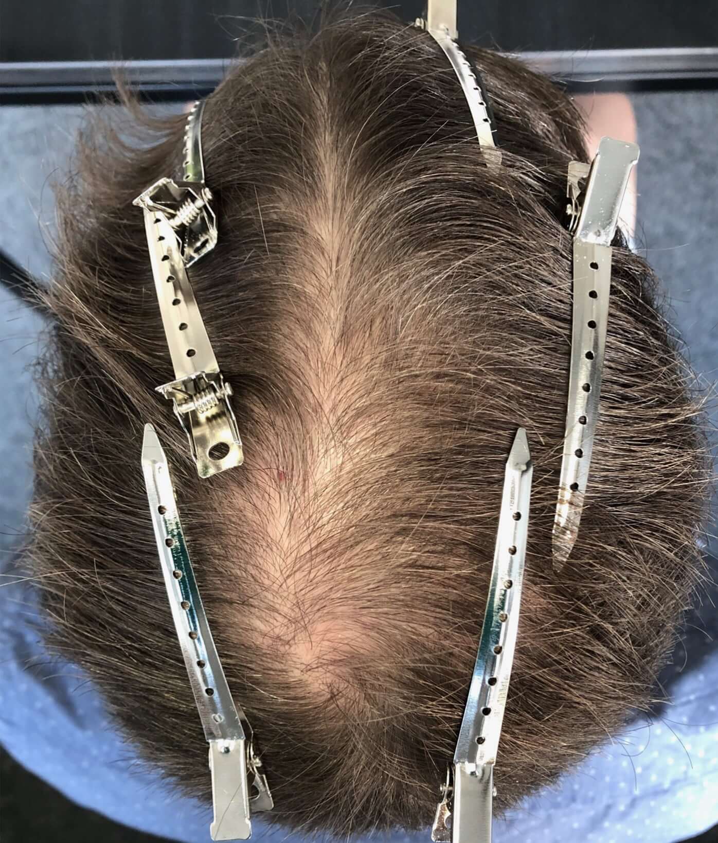 niostem - Wearable technology for hair re-growth