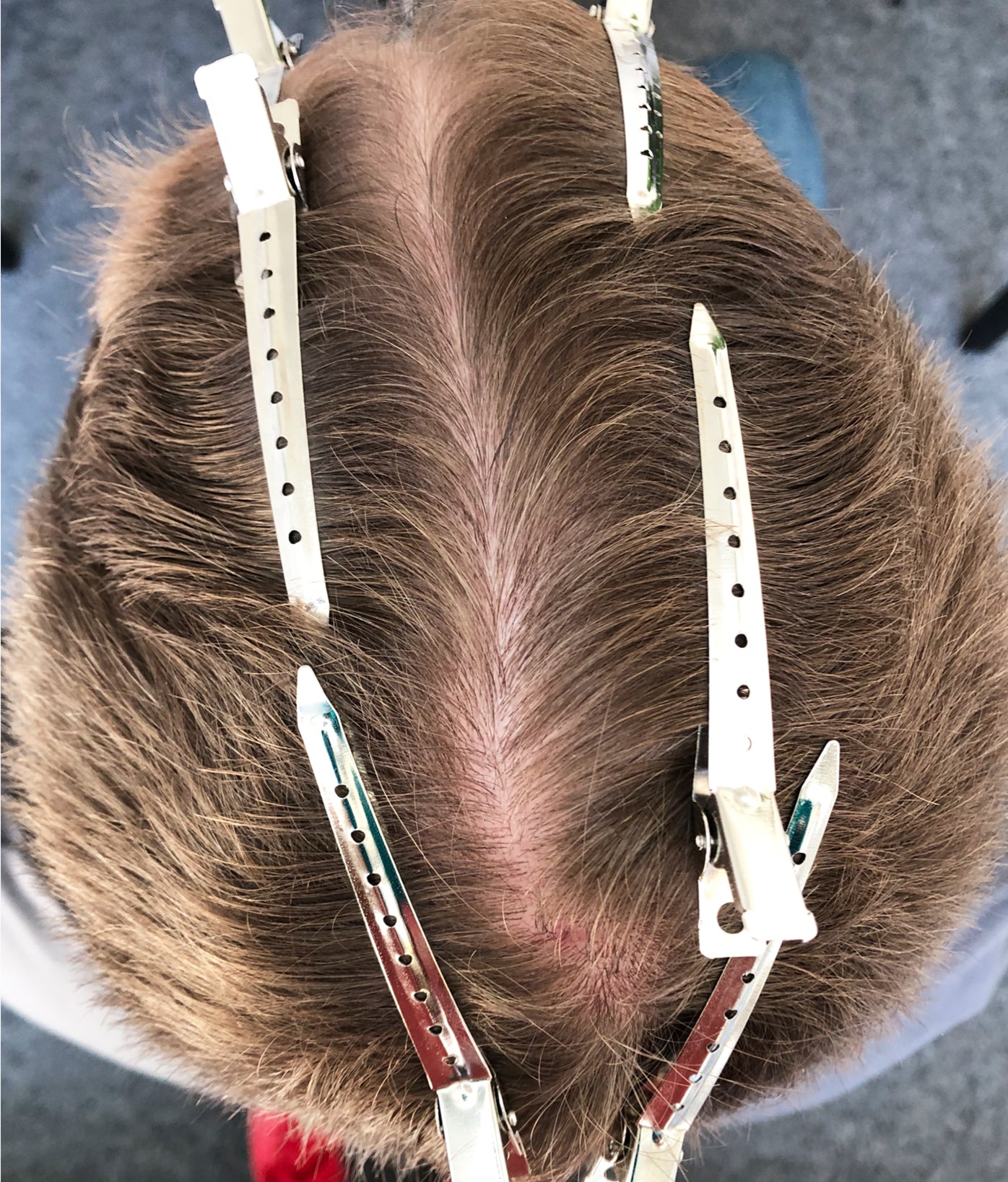niostem - Wearable technology for hair re-growth